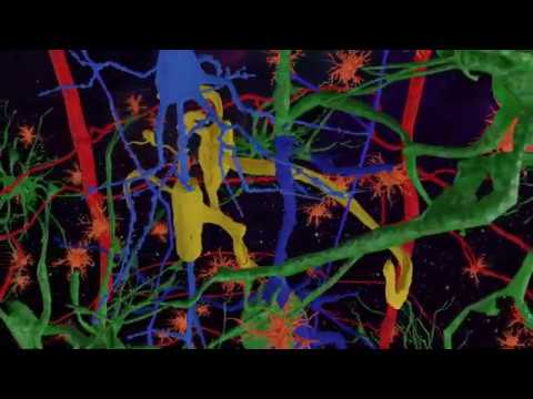 Demyelinating disease. White matter changes.