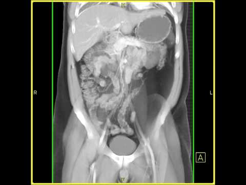 Miscellaneous: Lipoma of the Retroperitoneum: VRT