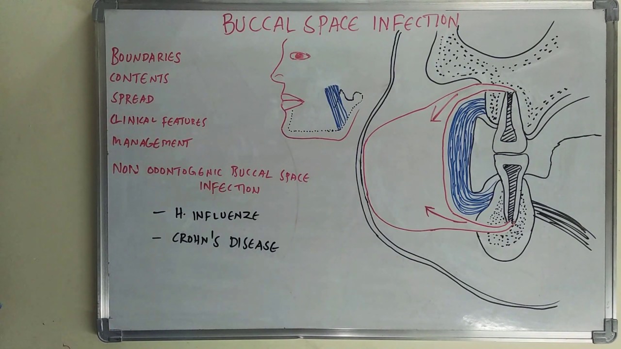 Buccal space infection