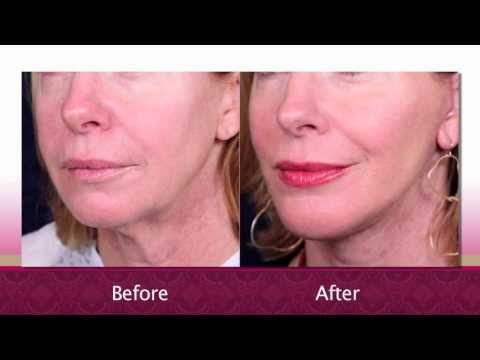 Facelift Augusta GA, Evans GA, Eatonton GA, Athens GA, Atlanta, Aiken South Carolina