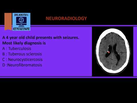 Tuberous sclerosis #Neuroradiology