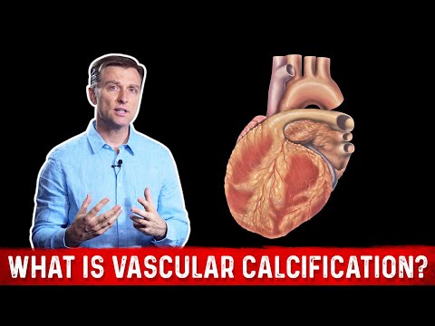 What Is Vascular Calcification? – Dr.Berg