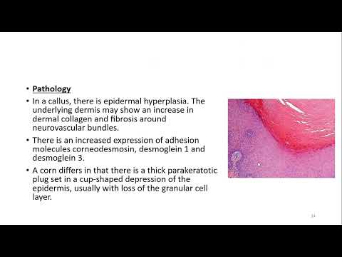 Lecture-231: Dermatoses due to Mechanical Injury to the Skin. Rook Chapter 122. 10th eds