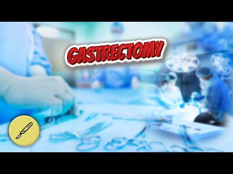 Gastrectomy - Everything Surgeries ✅😬⁉️