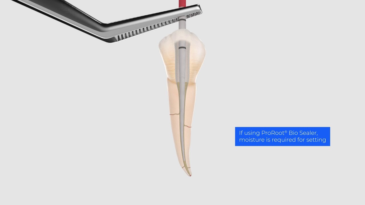 Carrier‑Based Technique with AH Plus® Jet Endodontic Sealer and GuttaCore® Obturators