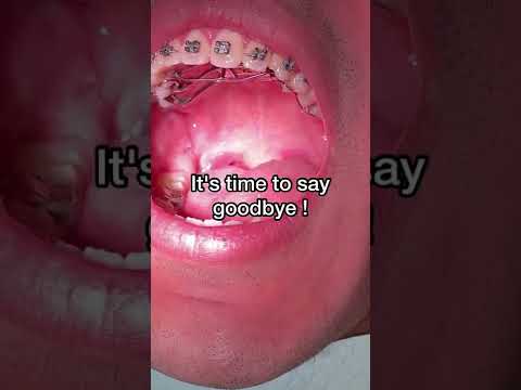 How to remove a tongue crib? Tooth Time Family Dentistry New Braunfels