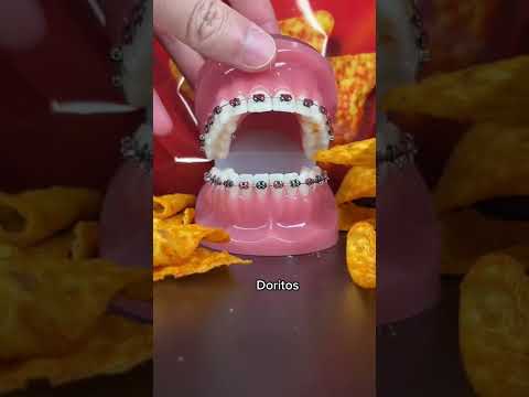 Chips to avoid with braces #braces #chips
