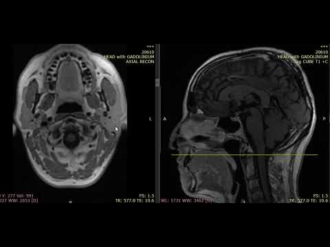 Radiology miss - Fatty infiltration in the upper cervical spine MRI