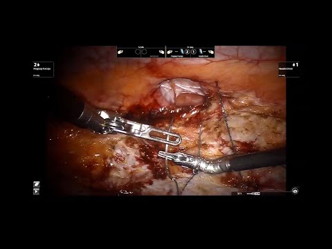 Primary Fascial Closure During Robotic Incisional Hernia Repair