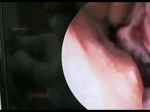 Diagnostic nasal endoscopy