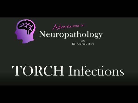 TORCH Infections: An autopsy review of a premature fetus with an intrauterine Herpes Simplex Virus.