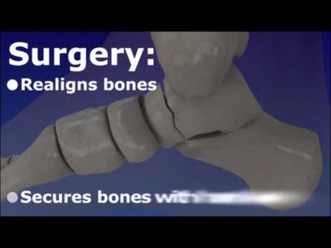 Hindfoot Fracture