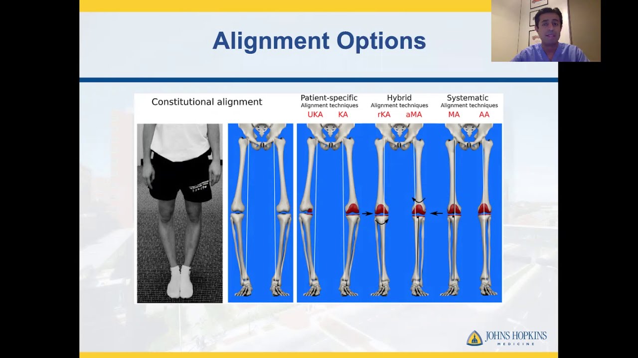 Kinematic Alignment (KA) for Arthritic Knee Conditions | Dr. Savya Thakkar