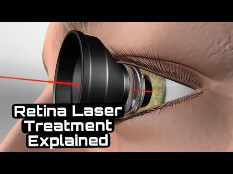 What is it like to get Retinal Laser Eye Surgery done/ Retina laser/ #barragelaser