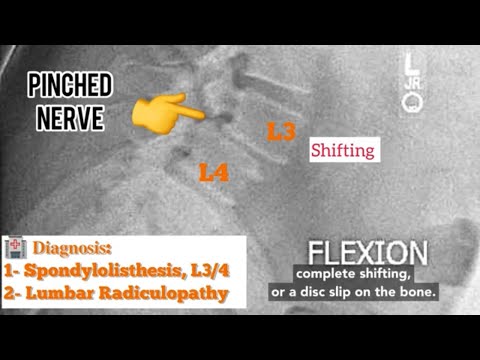Lumbar Spine Fusion for โDisc Slipโ (Case Presentation)