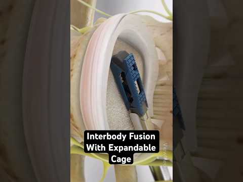 Lifting your spine with an expandable cage (3D Animation)