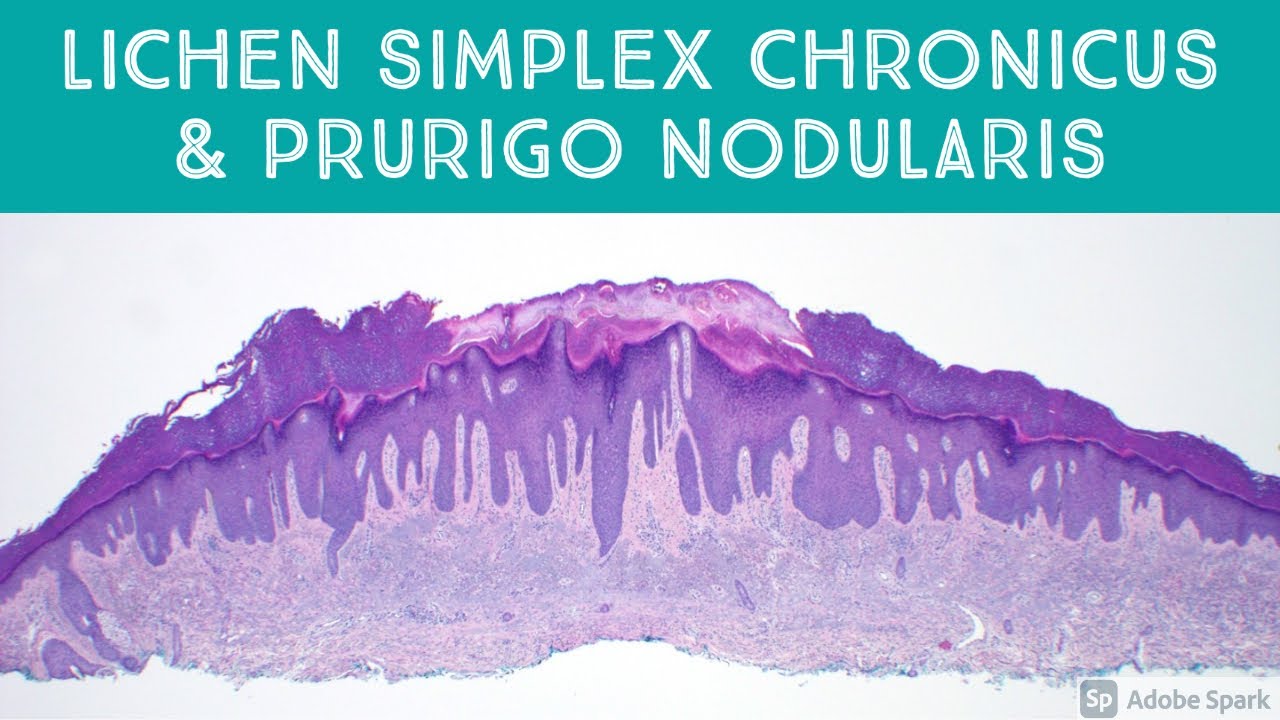 Lichen Simplex Chronicus & Prurigo Nodularis: The 