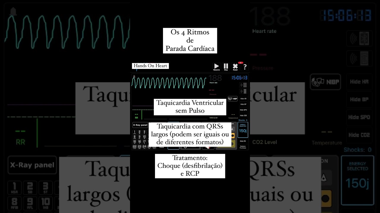 Os 4 ritmos de Parada Cardíaca.        #ecg #taquicardia #eletrocardiograma #cardiologia