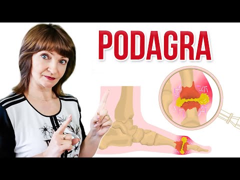 PODAGRA (dna moczanowa) - NATURALNE metody. - Fakto.pl