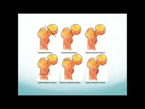 Hip Fractures: The basics