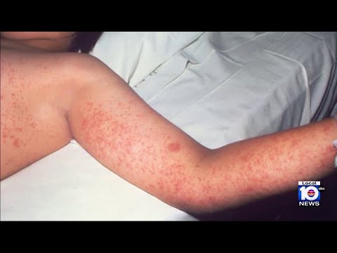 Medical experts urge health safety after measles cases in 2025 pass last year's total