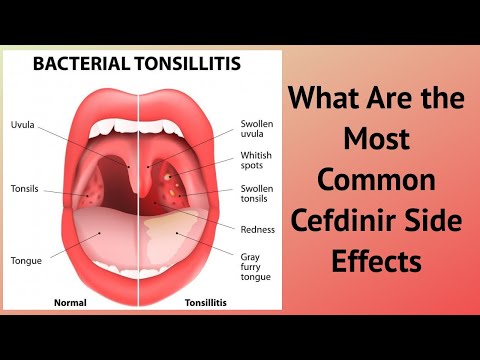 What Are the Most Common Cefdinir Side Effects