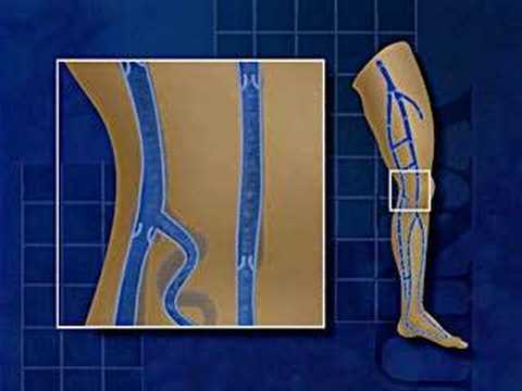 What Causes Varicose Veins?