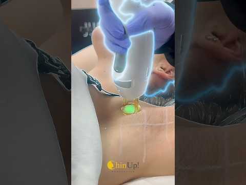 Candela Laser Hair Removal Treatment ✨🤩 #atlantageorgia #atlantaesthetician #laserhair