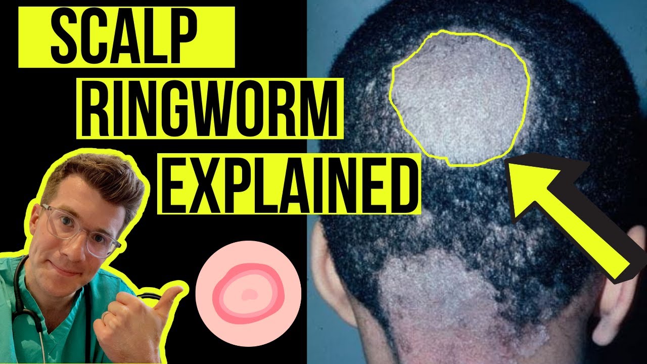 Doctor explains Scalp Ringworm (Tinea Capitis) including causes, symptoms, treatment & more!