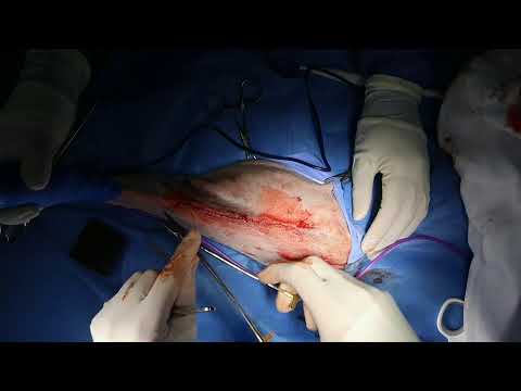 live stream on intermuscular lipoma in a dog