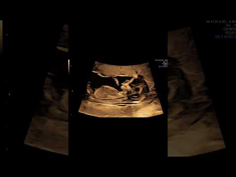 NT ஸ்கேனில் கண்டறியப்படும் முக்கிய அம்சங்கள் #drvandanaa #ntscan #scan #shukrandiagnostics