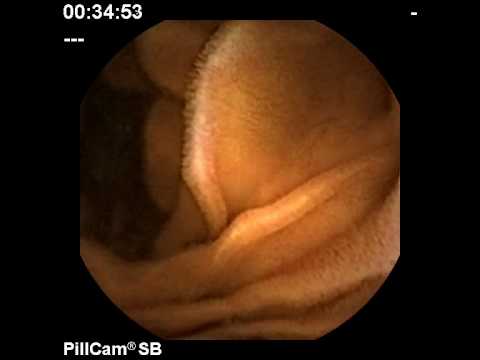 capsule endoscopy Crohns pseudopolyp.mpg