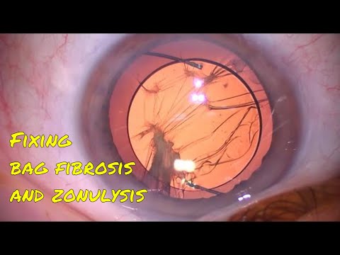 IOL From Sulcus to Capsular Bag: Managing postoperative capsular fibrosis and zonular dialysis