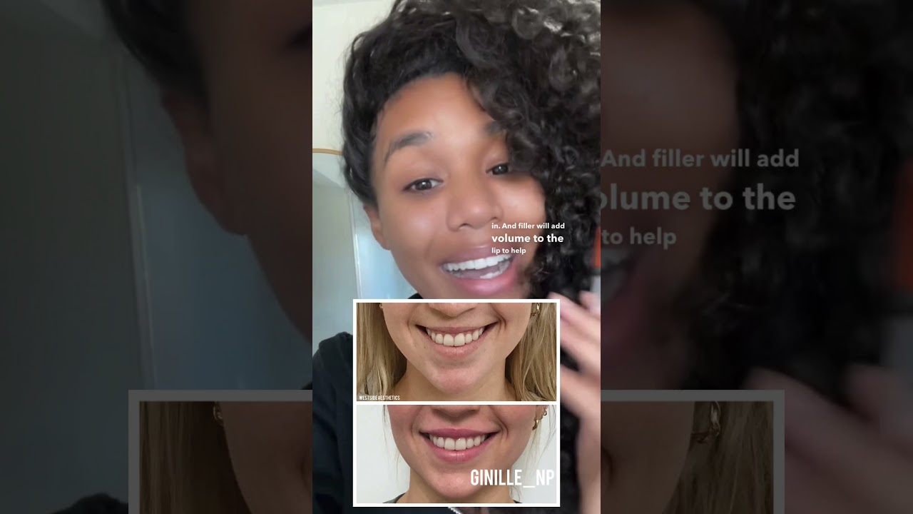 Botox lip flip, gummy smile treatment, before and after lip filler, upper lip Botox, gummy smile, LA