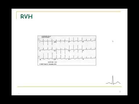Abnormal ECG part 2