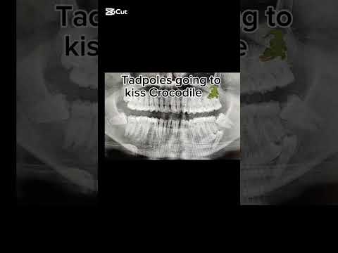 Ectopic Teeth: Supernumerary Teeth | Tadpoles Teeth kissing a Crocodile 🐊#dentist #dentalartistry