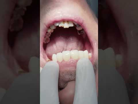 Zirconia crowns to protect root canal treated teeth #dentist