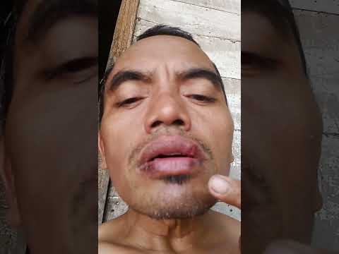 apa obat sariawan yang ampuh