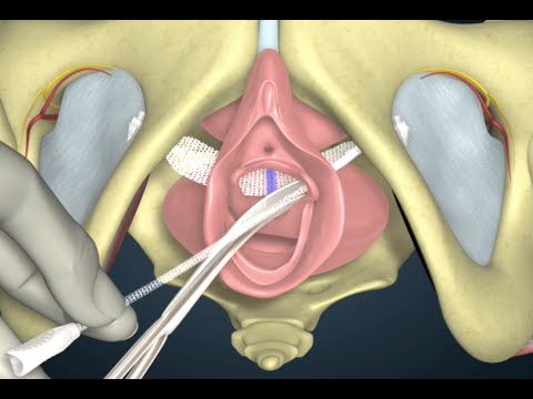 CR Bard: Ajust™ Vaginal Bladder Sling