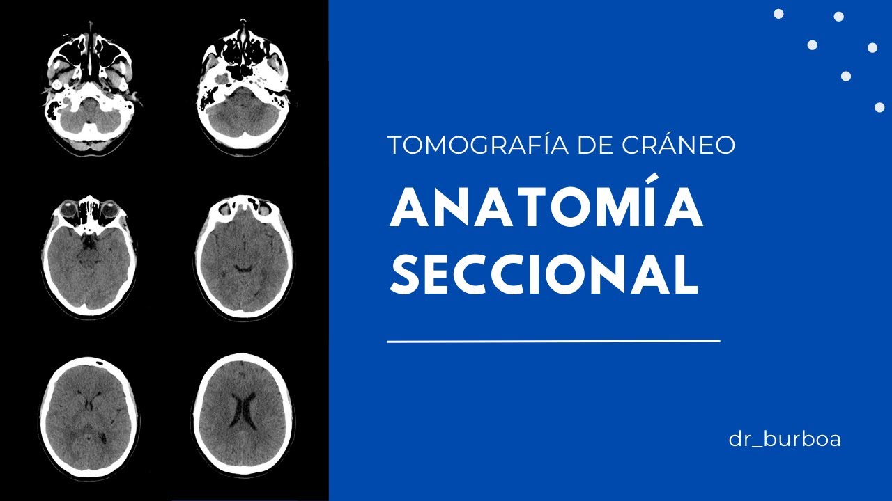 ANATOMÍA SECCIONAL DE CRÁNEO