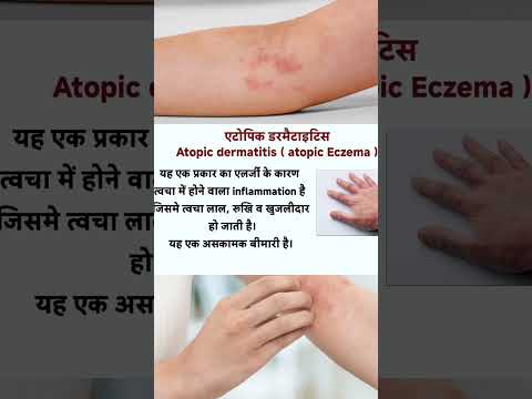 atopic dermatitis symptoms in hindi | shorts #shortfeed