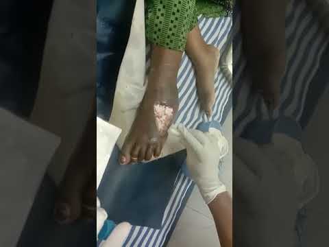 Medifil II Particles - Medifil Particles 15 ml Manufacturer from Ahmedabad