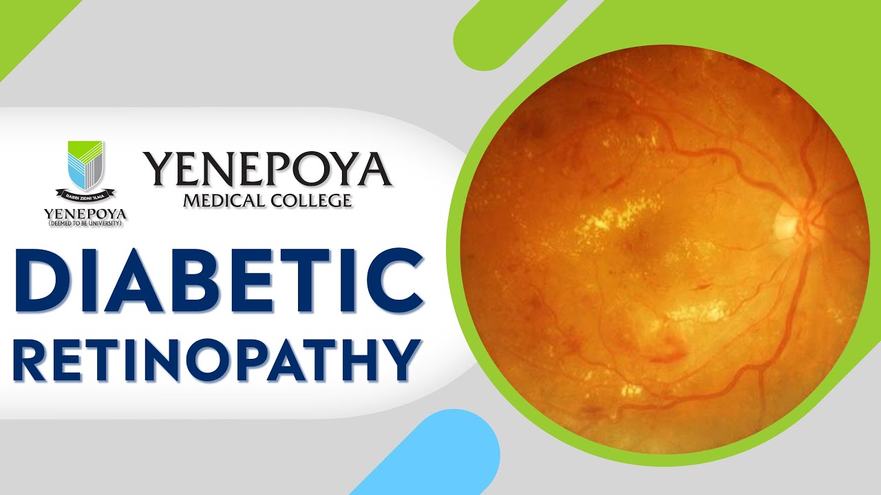 Diabetic Retinopathy | Ophthalmology | Yenepoya Medical College