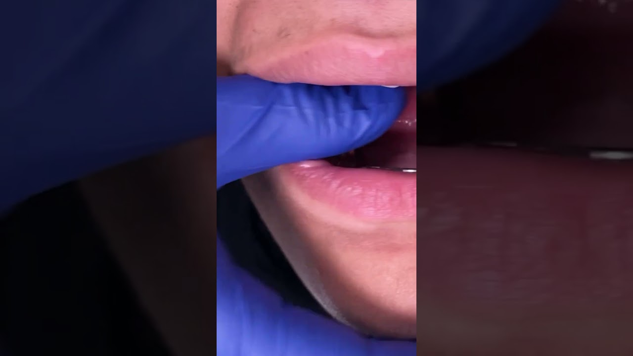 Palatal Expanders- 15 year old patient - Upper RPE plus Expander and Lower Expander - Toothtime