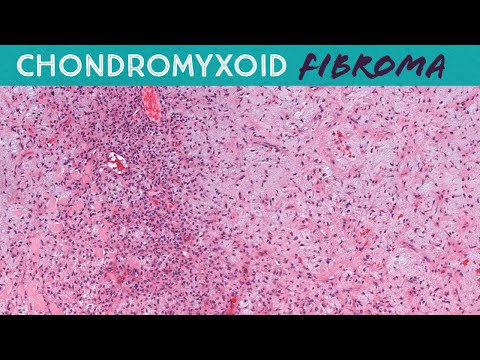 Chondromyxoid Fibroma CMF - Bone Pathology Basics (Yale case 8)