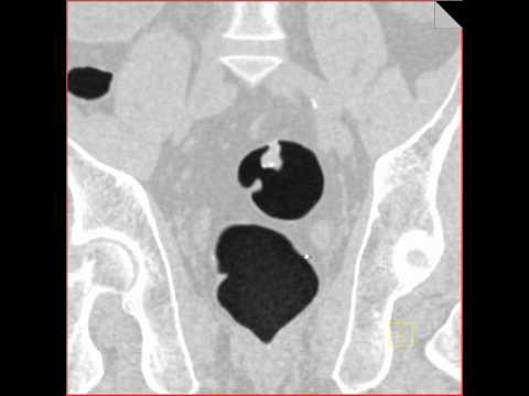CASE1B.avi