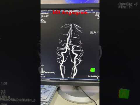 MRI Post Contrast Angiogram and Venogram On Siemens 3T MRI