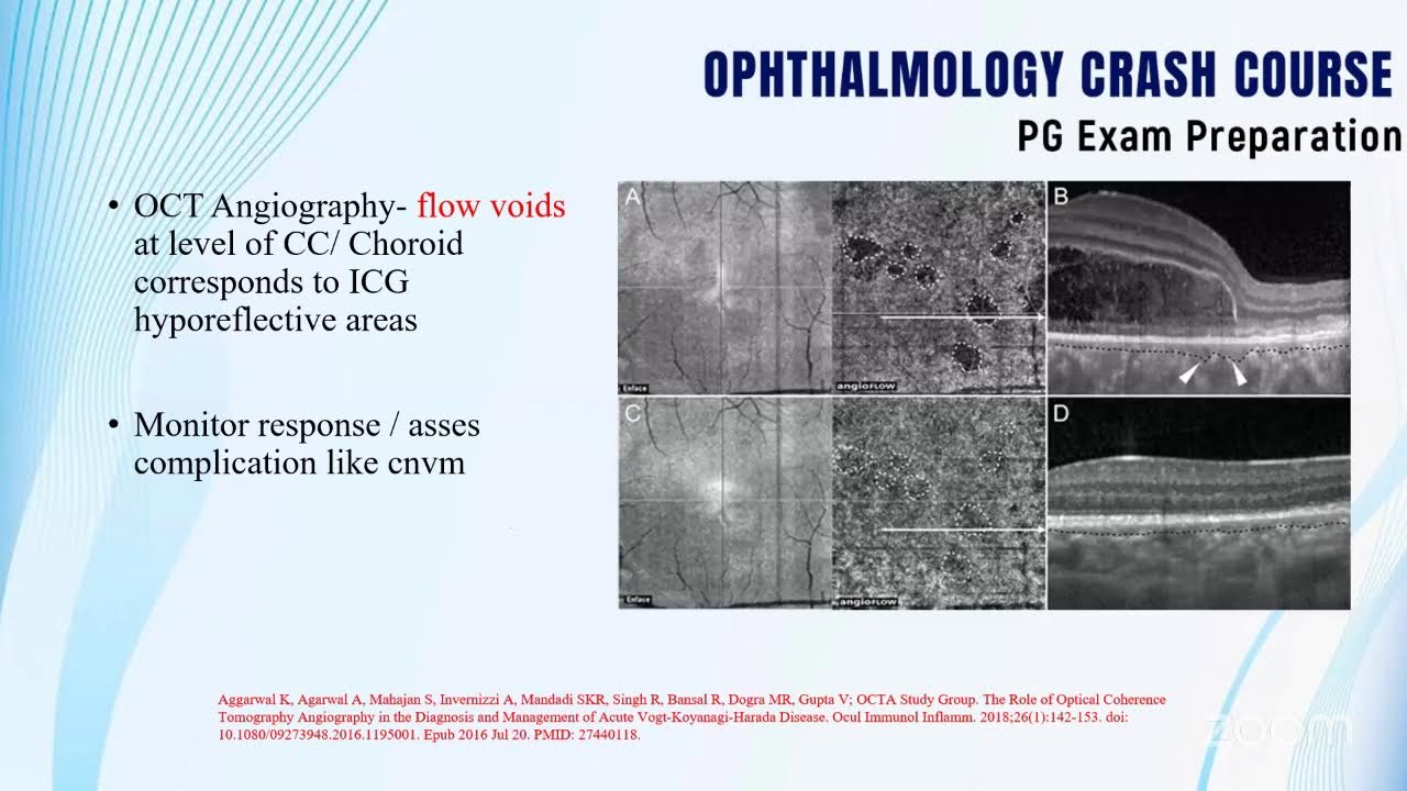 OPHTHALMOLOGY CRASH COURSE - PG Exam Preparation Webinar