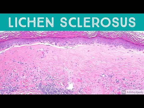 Lichen Sclerosus et atrophicus: Inflammatory Dermpath Basics for Dermatology & Pathology