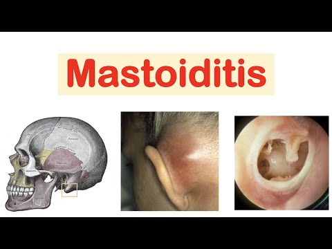 Mastoiditis (& Acute Otitis Media) | Causes, Pathophysiology, Symptoms, Diagnosis, Treatment